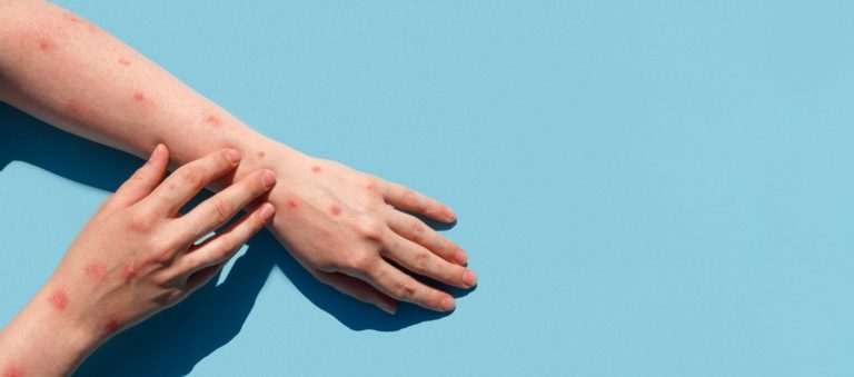 FDA Advises to Use Lesion Swab for Monkeypox Testing - Xtalks