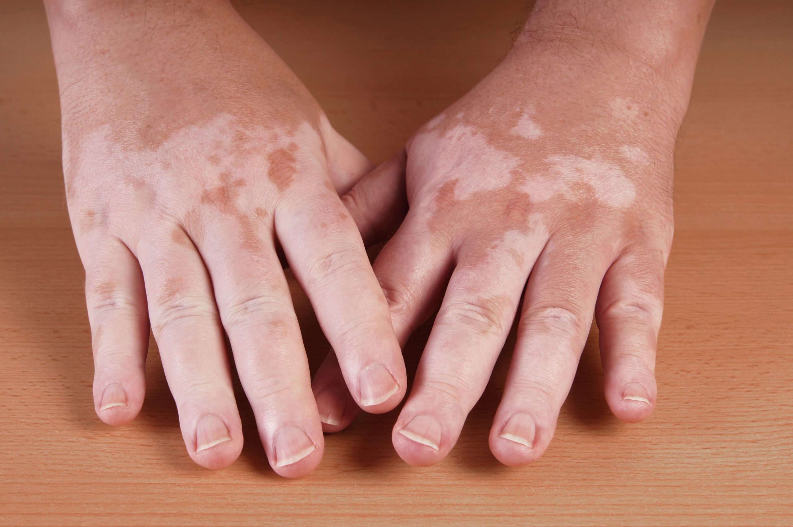 Opzelura Vitiligo Med Wins FDA Approval as First Treatment for ...