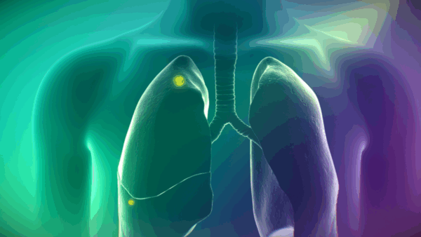 Imaging Drug Cytalux (pafolacianine) Approved for Detection of Lung ...