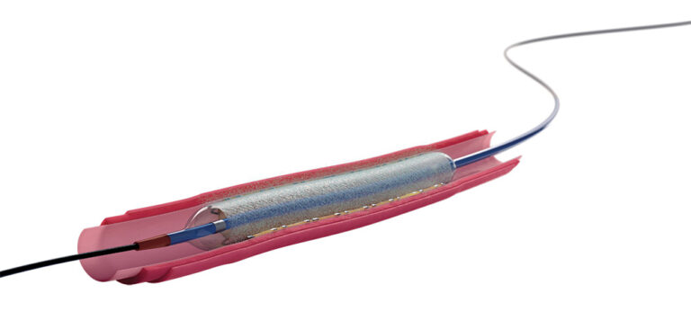 Agent Drug-Coated Balloon: A New Era in Coronary In-Stent Restenosis ...